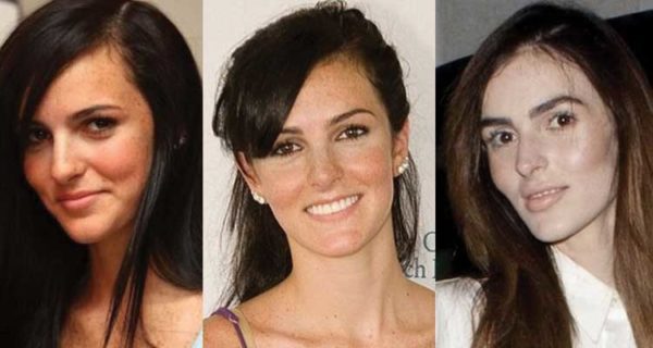 Ali Lohan Plastic Surgery Before and After Pictures 2025